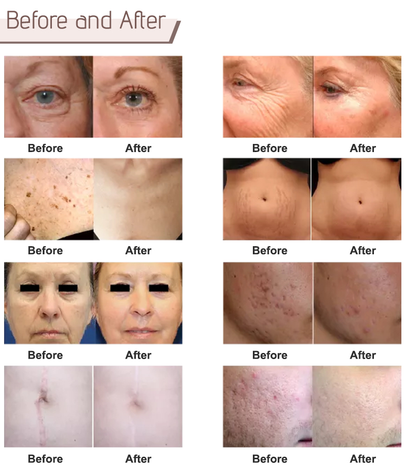 Fractional Co2 Laser Skin Resurfacing Machine - Buy c02 fractional ...